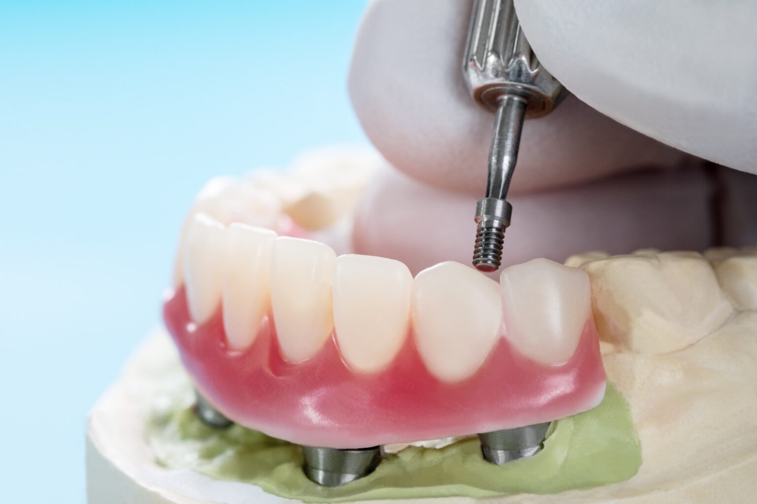 Prótese Protocolo – H. Odontologia, Implante Dental, Clínica de ...